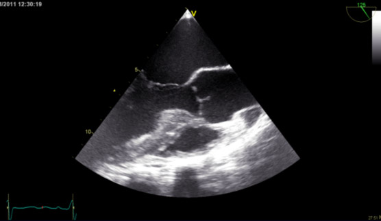 Trans-Oesophageal Echocardiogram - Riverina Cardiology
